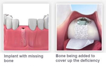 Bone Augmentation - The Denture & Implant Clinic