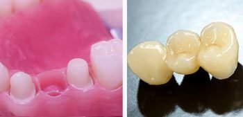 Options for replacing a single missing tooth | The Denture & Implant Clinic