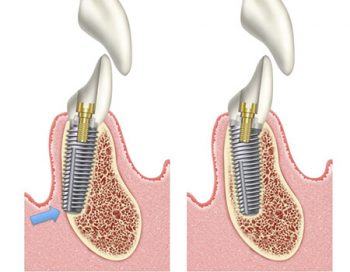 What is the Southern Dental Implant system and why do we use it at our ...